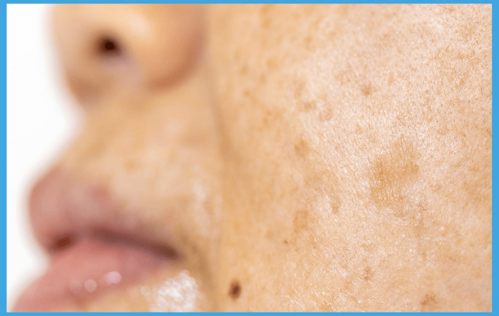 Ways to Identify and Treat Hyperpigmentation - Astute Clinic