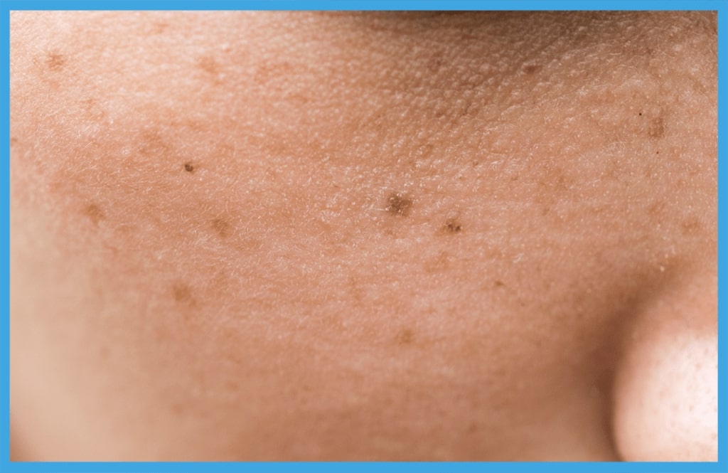 Ways to Identify and Treat Hyperpigmentation - Astute Clinic